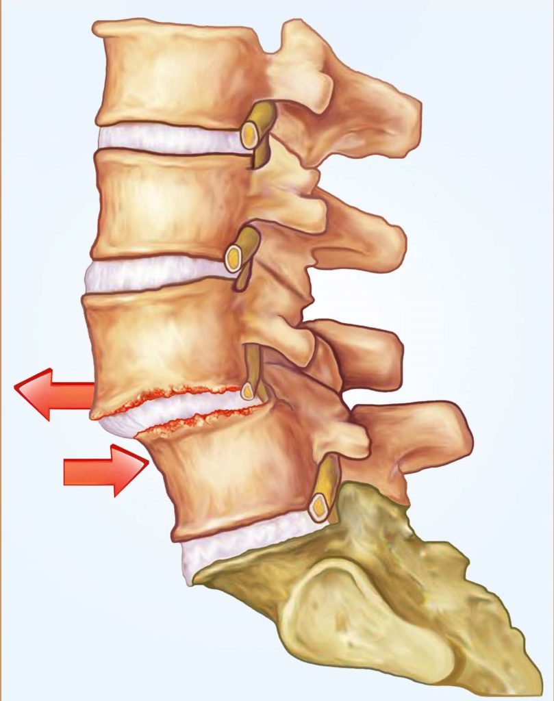 Spondylolisthesis - post 4 - Disability Counsel